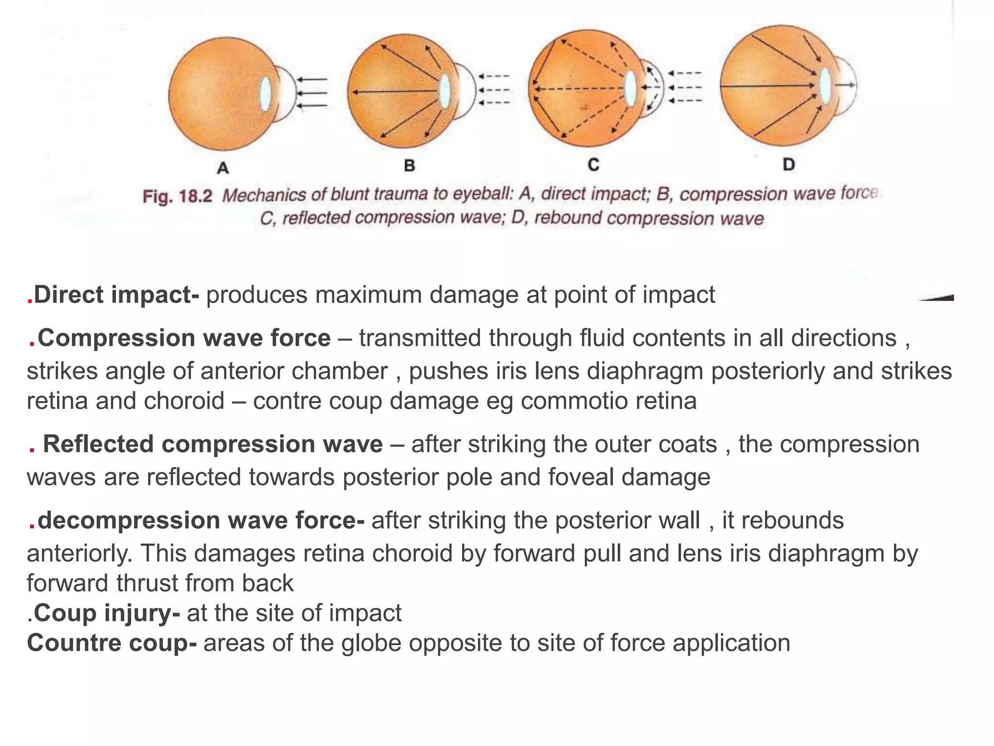 Blunt Ocular trauma | PPTX