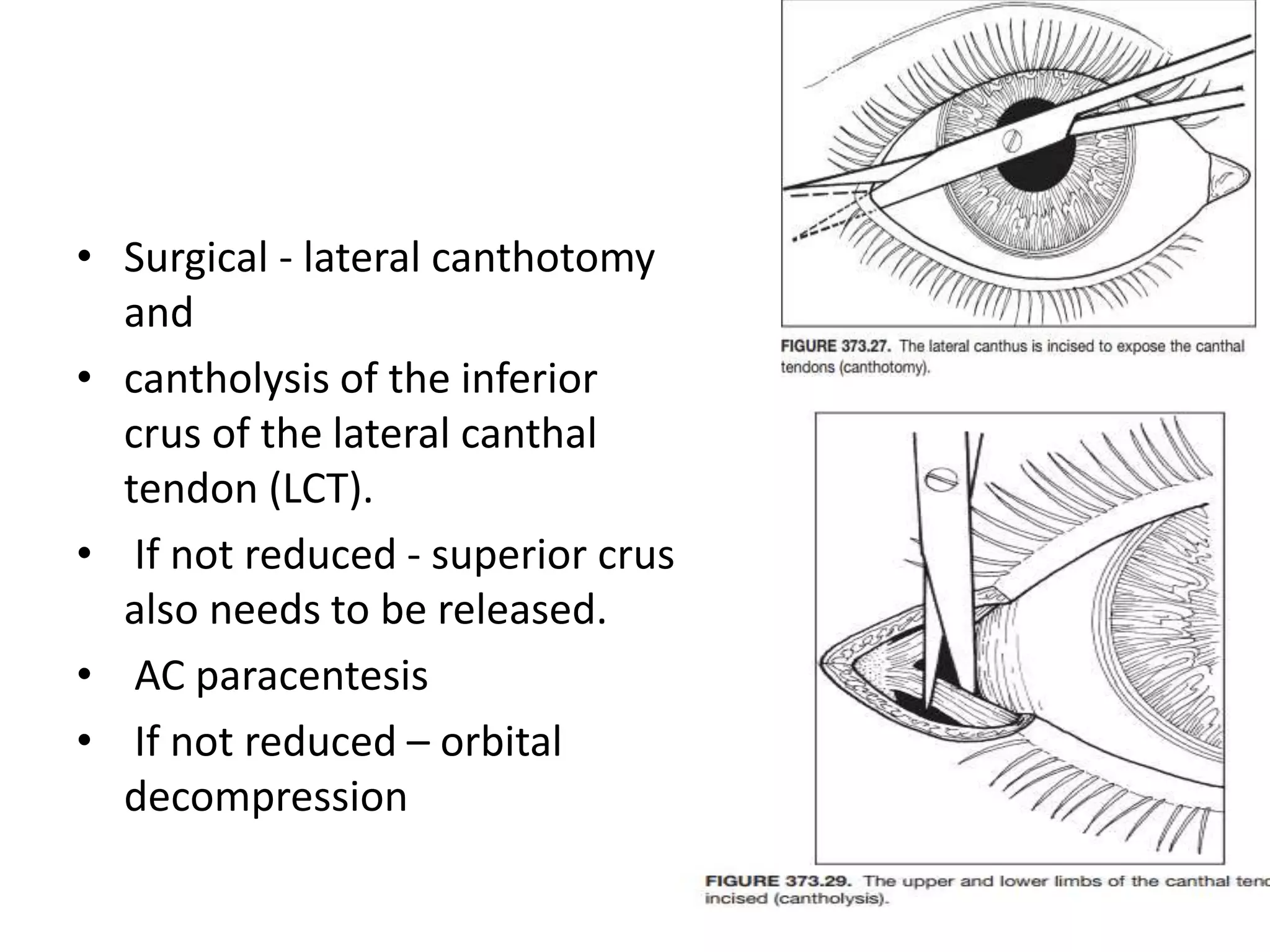 Blunt Ocular trauma | PPTX