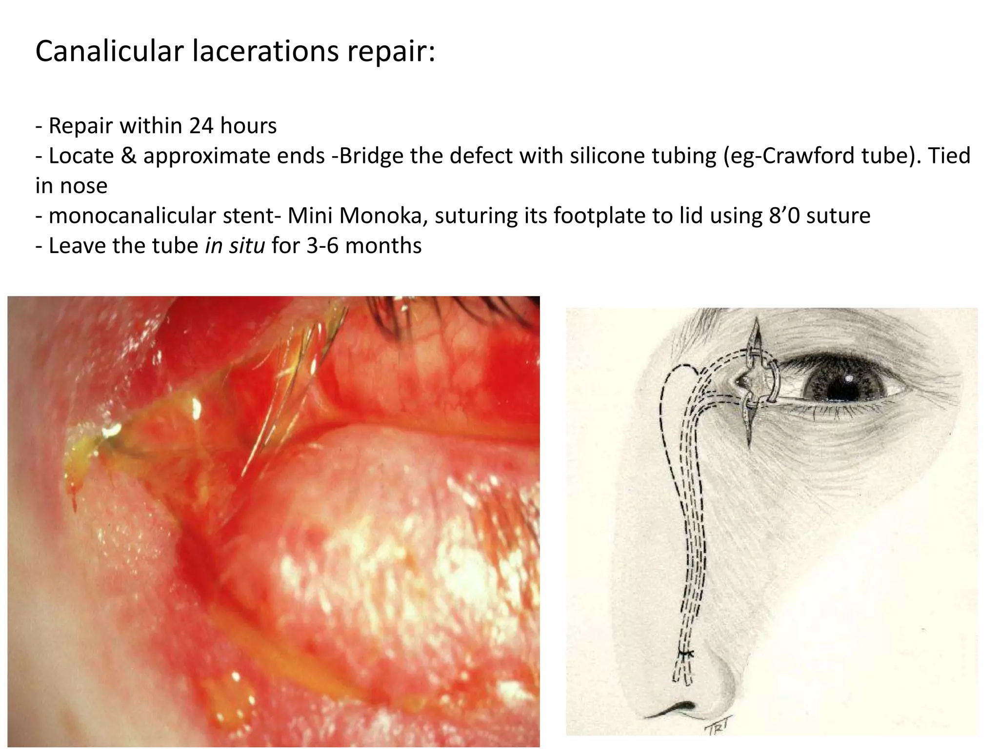 Blunt Ocular trauma | PPTX