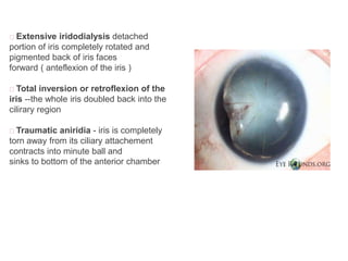 Blunt Ocular trauma | PPTX