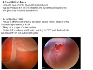 Blunt Ocular trauma | PPTX