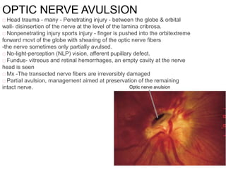 Blunt Ocular trauma | PPTX