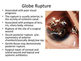 Blunt Ocular trauma | PPTX