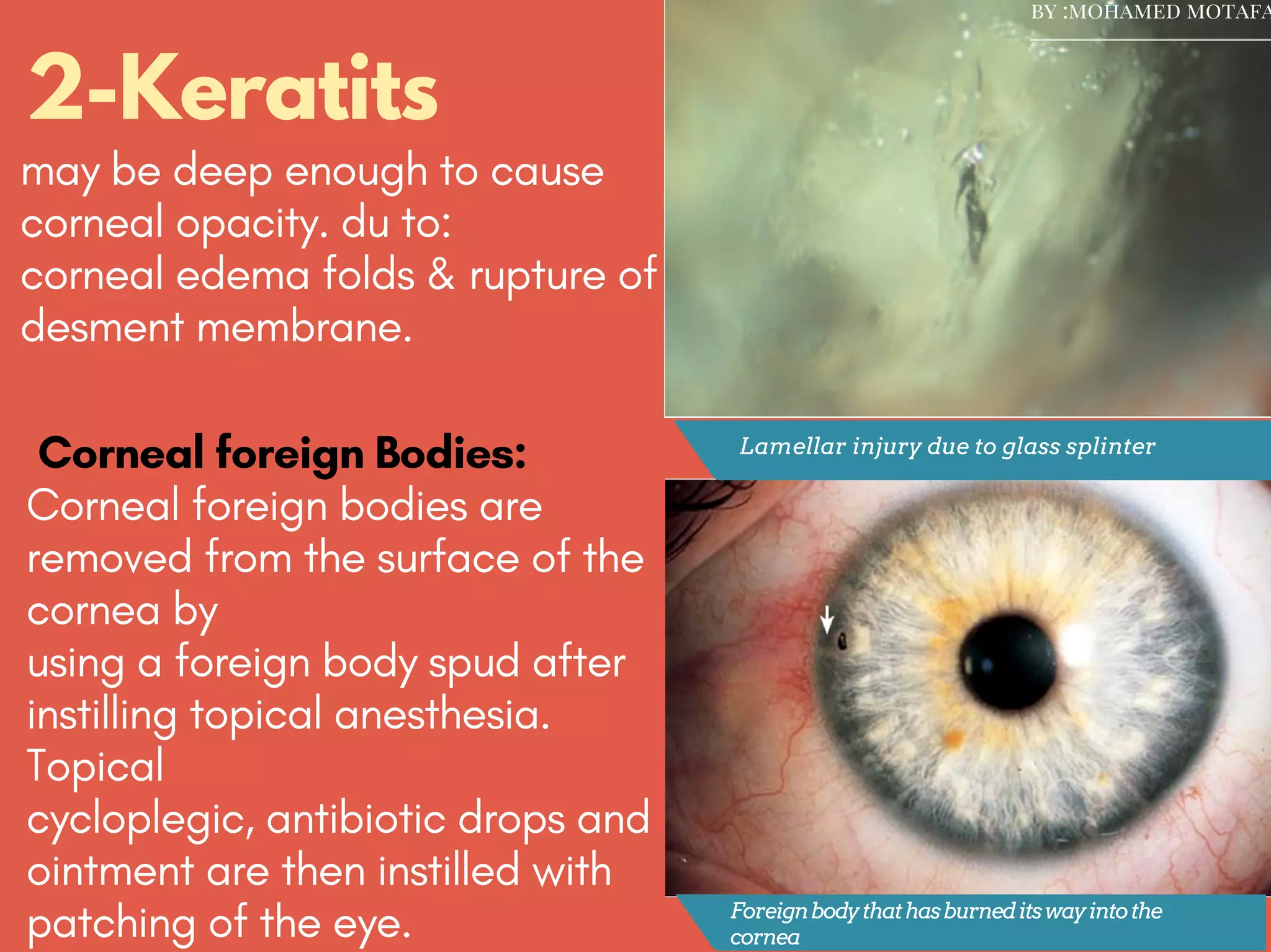 Ocular trauma ..effect on cornea and sclera | PDF
