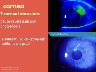 Ocular trauma ..effect on cornea and sclera | PPT