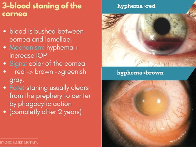 Ocular trauma ..effect on cornea and sclera | PPT