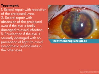 Ocular trauma ..effect on cornea and sclera | PPT