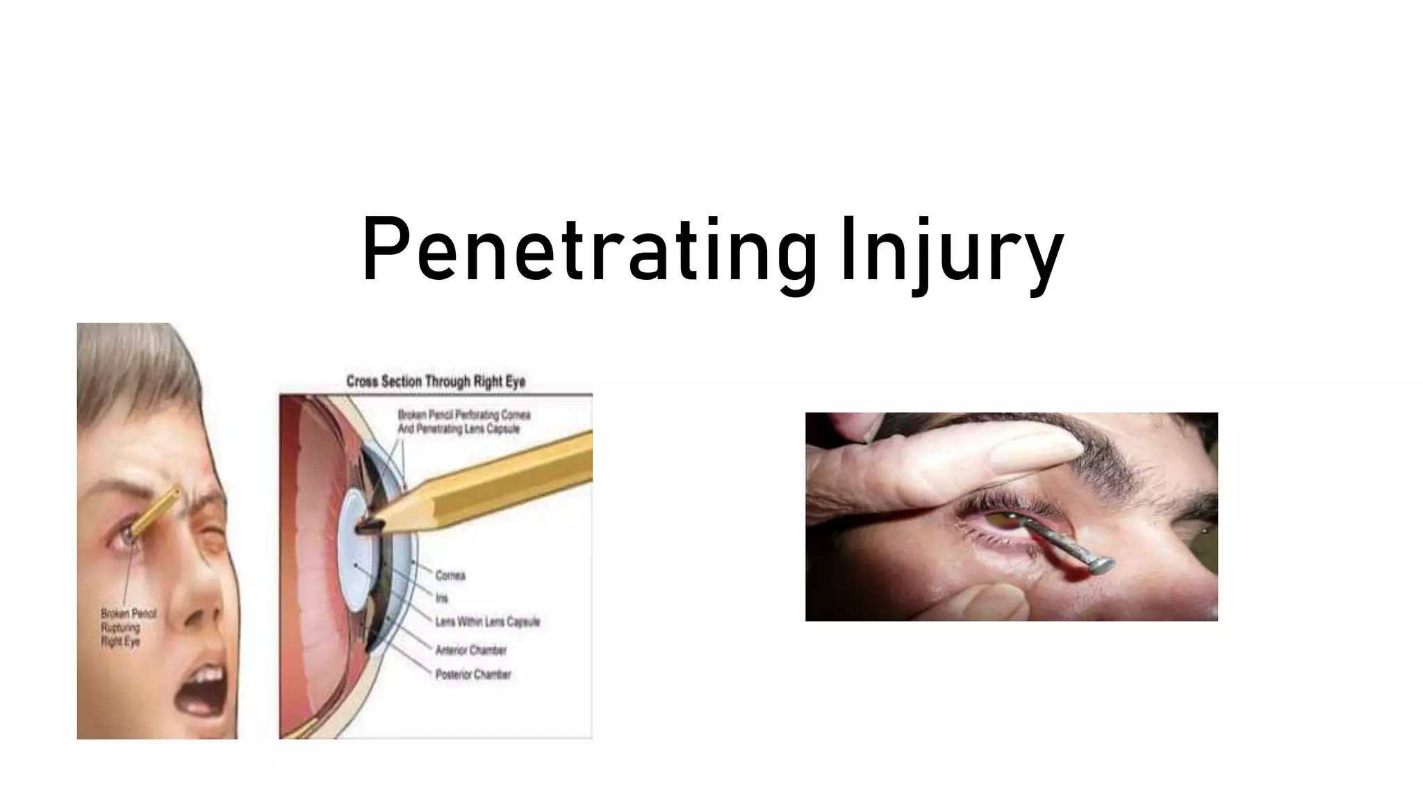 Ocular Trauma .pptx