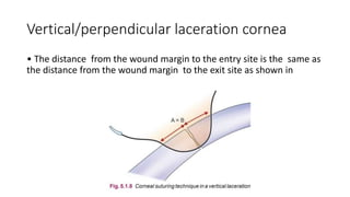 Ocular Trauma - Penetrating and Perforating wounds | PPTX