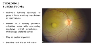 Ocular tuberculosis | PPTX | Eye and Vision Conditions | Diseases and ...