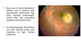 Ocular tuberculosis | PPTX