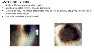 Ocular tuberculosis | PPTX