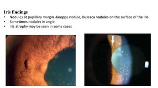 Ocular tuberculosis | PPTX