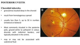 Choroidal Tubercles