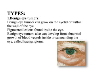 Ocular tumor | PPTX