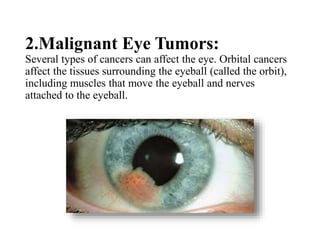 Ocular tumor | PPTX