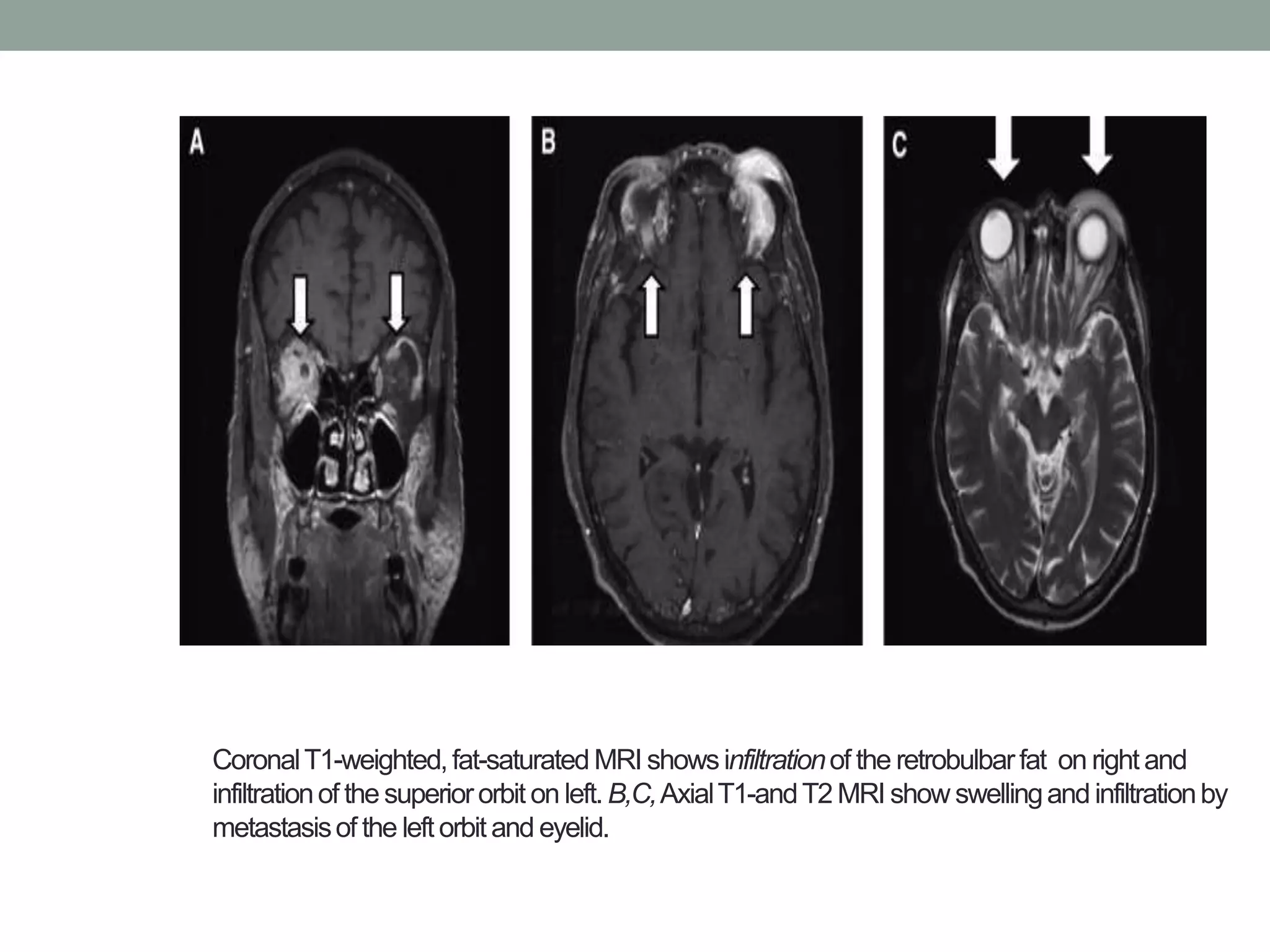 Tumors of the eye | PPTX