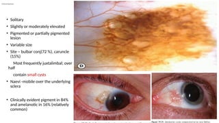 Pathology of Ocular Tumors: Classification, Features | PPTX