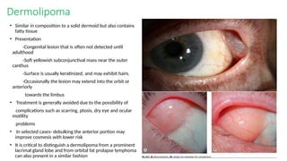 Pathology of Ocular Tumors: Classification, Features | PPTX