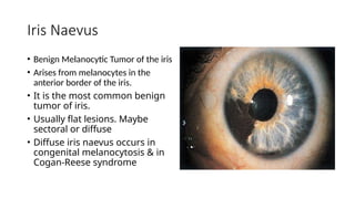 Pathology of Ocular Tumors: Classification, Features | PPTX