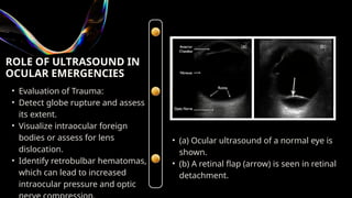 OCULAR Ultrasound IN EMERGENCIES (OUIE).pptx