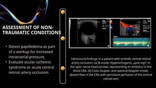 OCULAR Ultrasound IN EMERGENCIES (OUIE).pptx