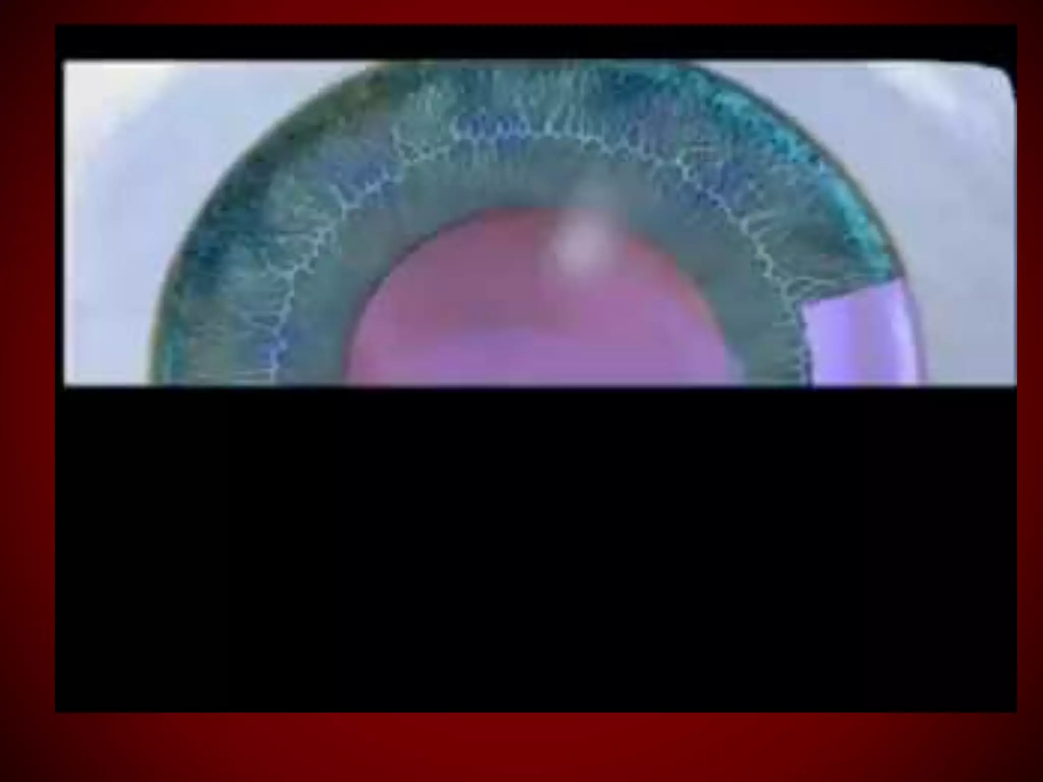 Ocular viscoelastic devices(OVD) | PPTX
