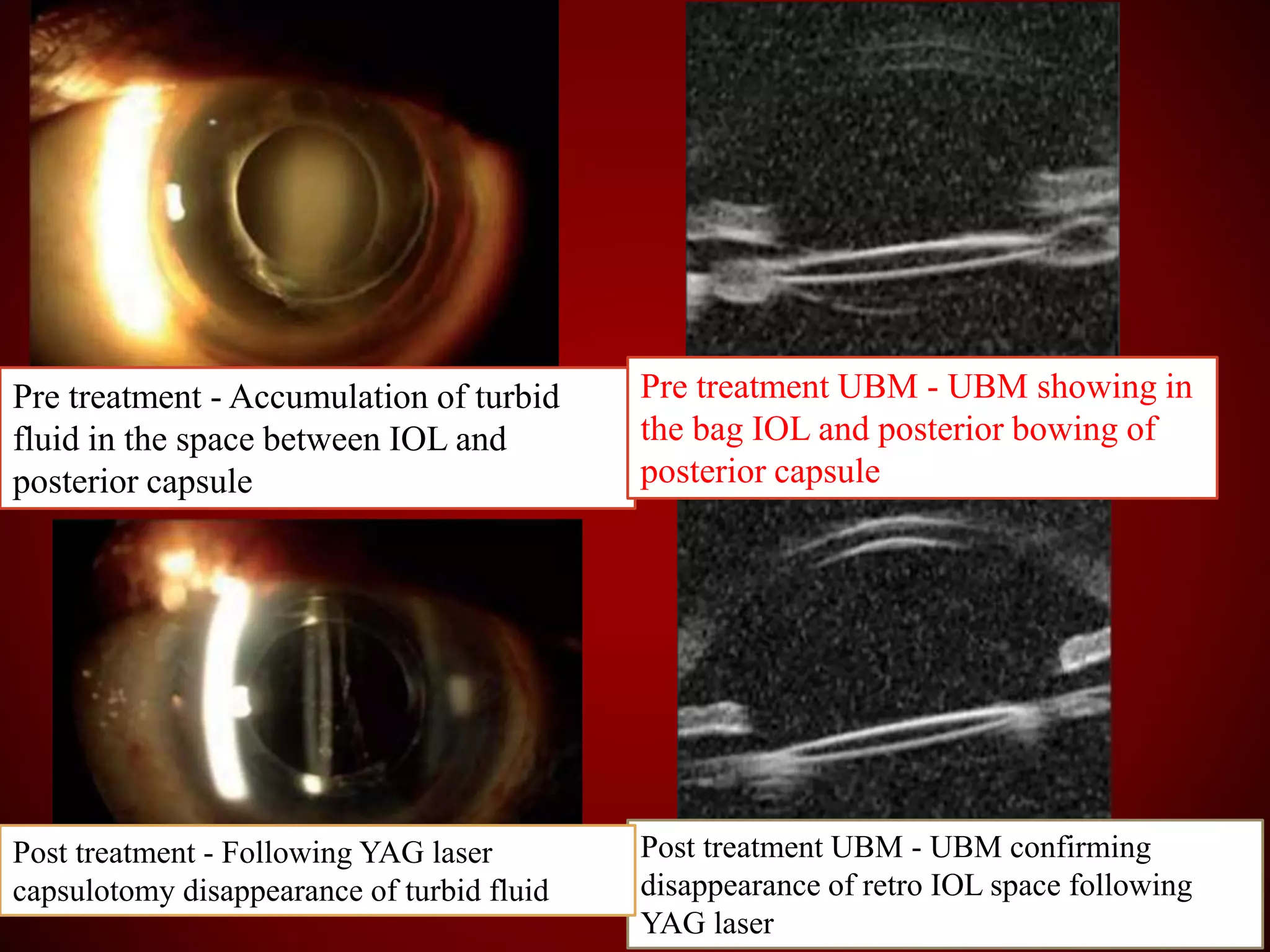 Ocular viscoelastic devices(OVD) | PPTX