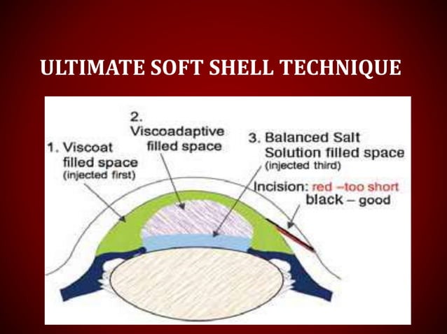Ocular viscoelastic devices(OVD) | PPTX