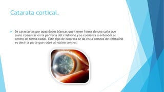 Oculista Guadalajara: Tipos de cataratas. | PPTX