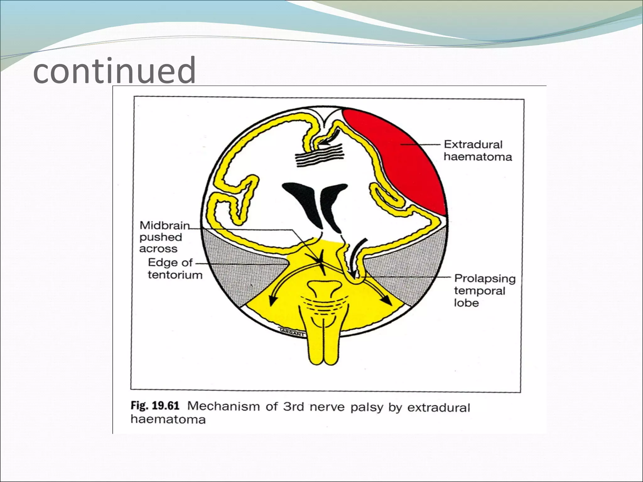 Oculomotor nerve palsy | PPT