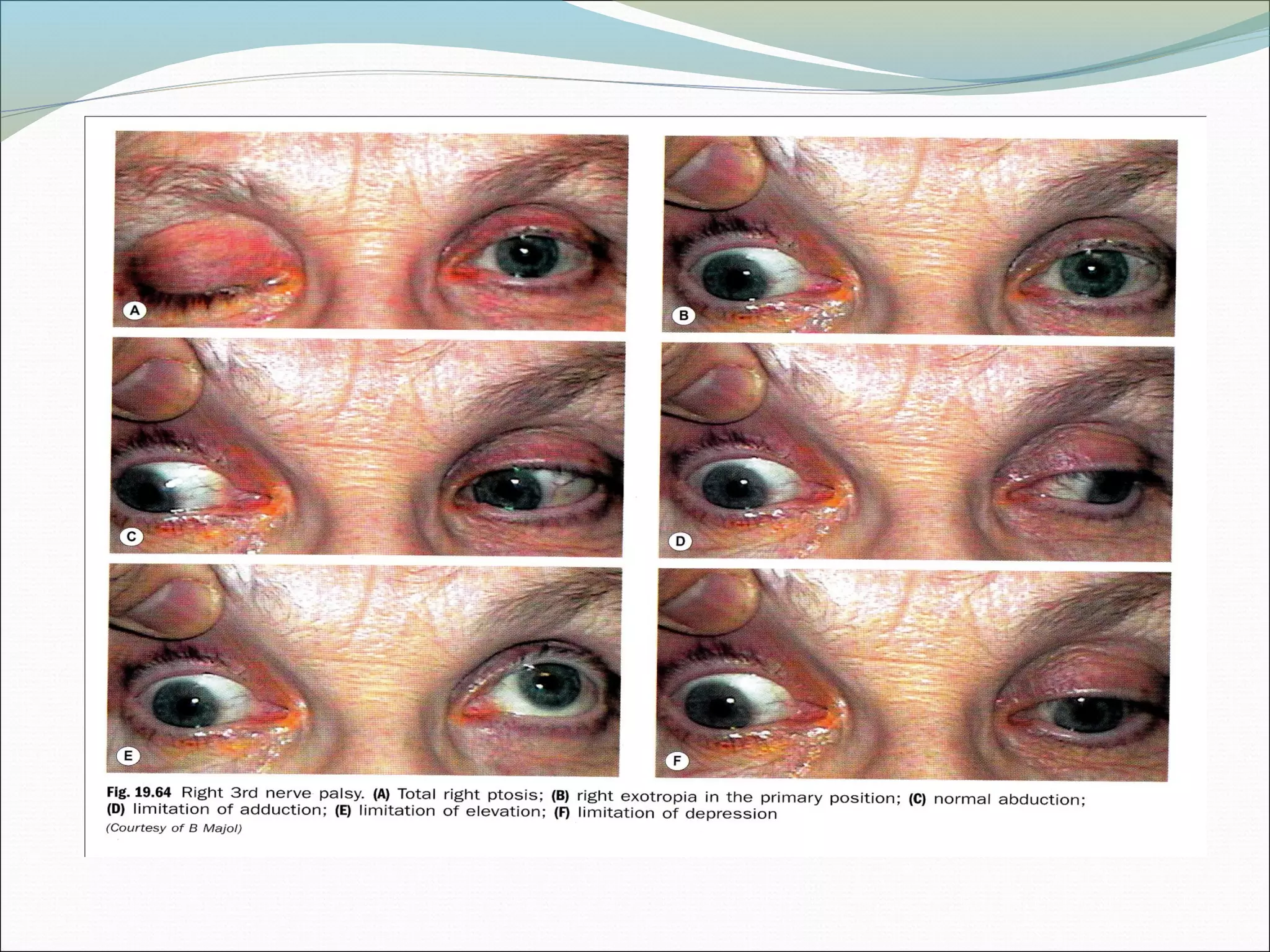 Oculomotor nerve palsy | PPT