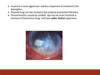 Oculomycosis modified | PPTX