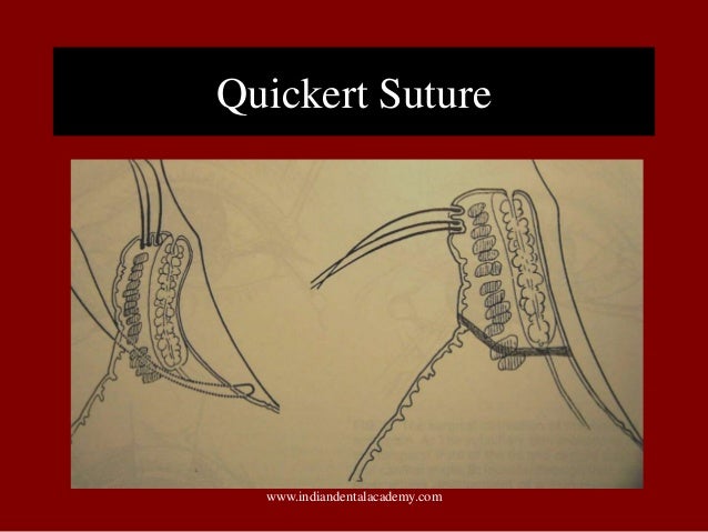 Oculoplastics review /certified fixed orthodontic courses by Indian d…