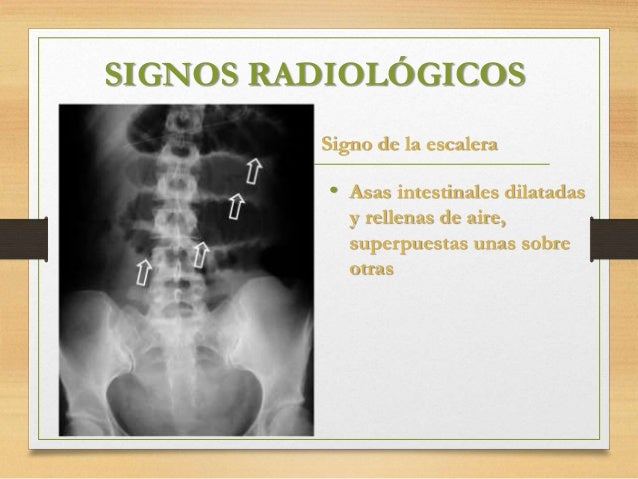 Oclusión intestinal