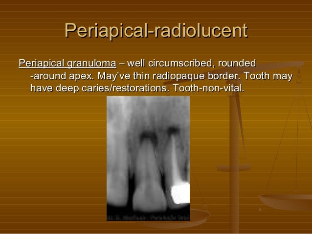 Periapical Granuloma Vs Cyst