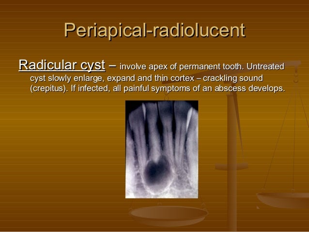 Radicular Cyst Radiology