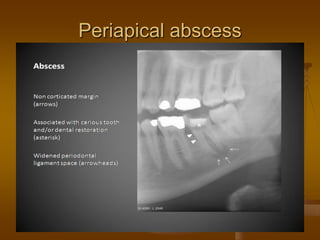 Periapical Abscess Radiograph