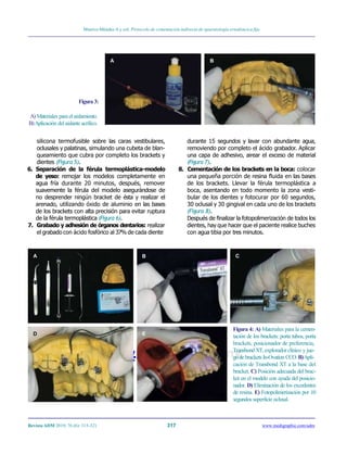 CEMENTACION INDIRECTA DE BRACKETS | PPTX