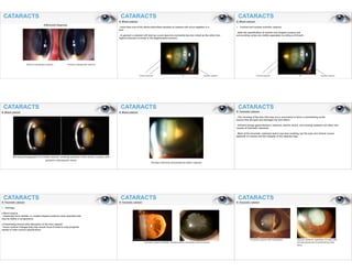 Cataract Cataract Cataract Cataract Cataract | PDF