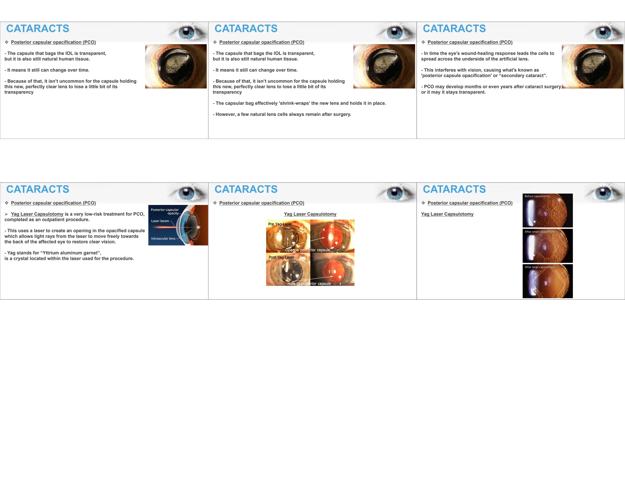 Ocular disease Cataract, crystalline lens | PDF