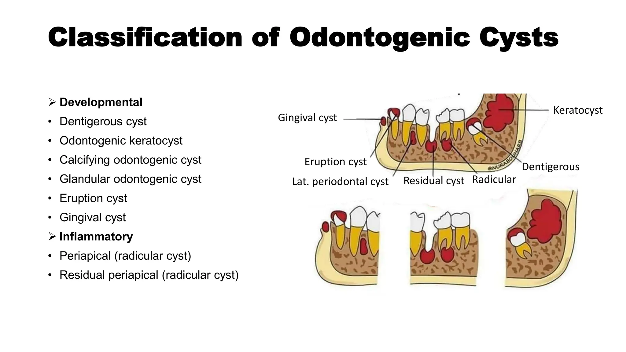 Classification and management Odontogenic cysts of oral cavity | PPTX