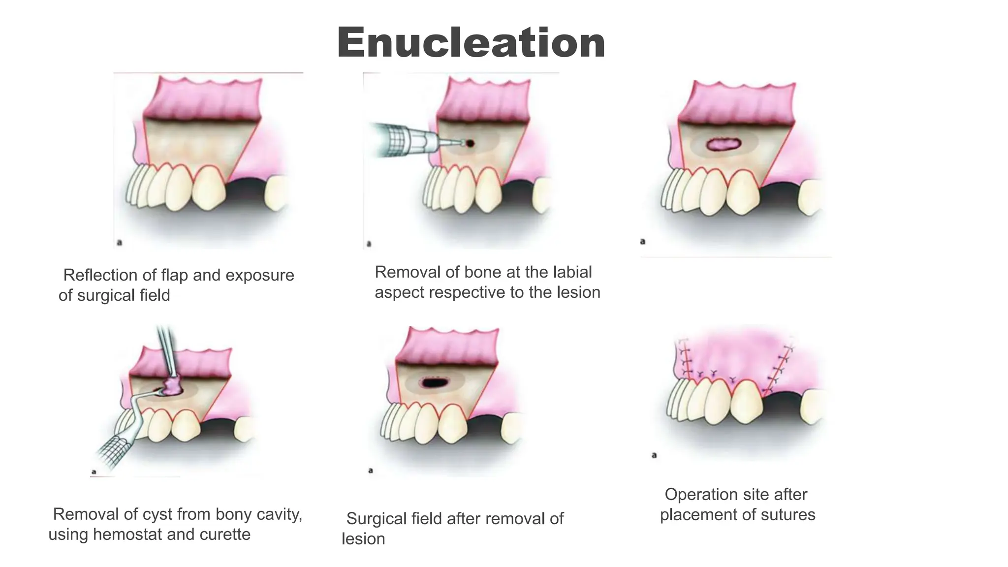 Classification and management Odontogenic cysts of oral cavity | PPTX