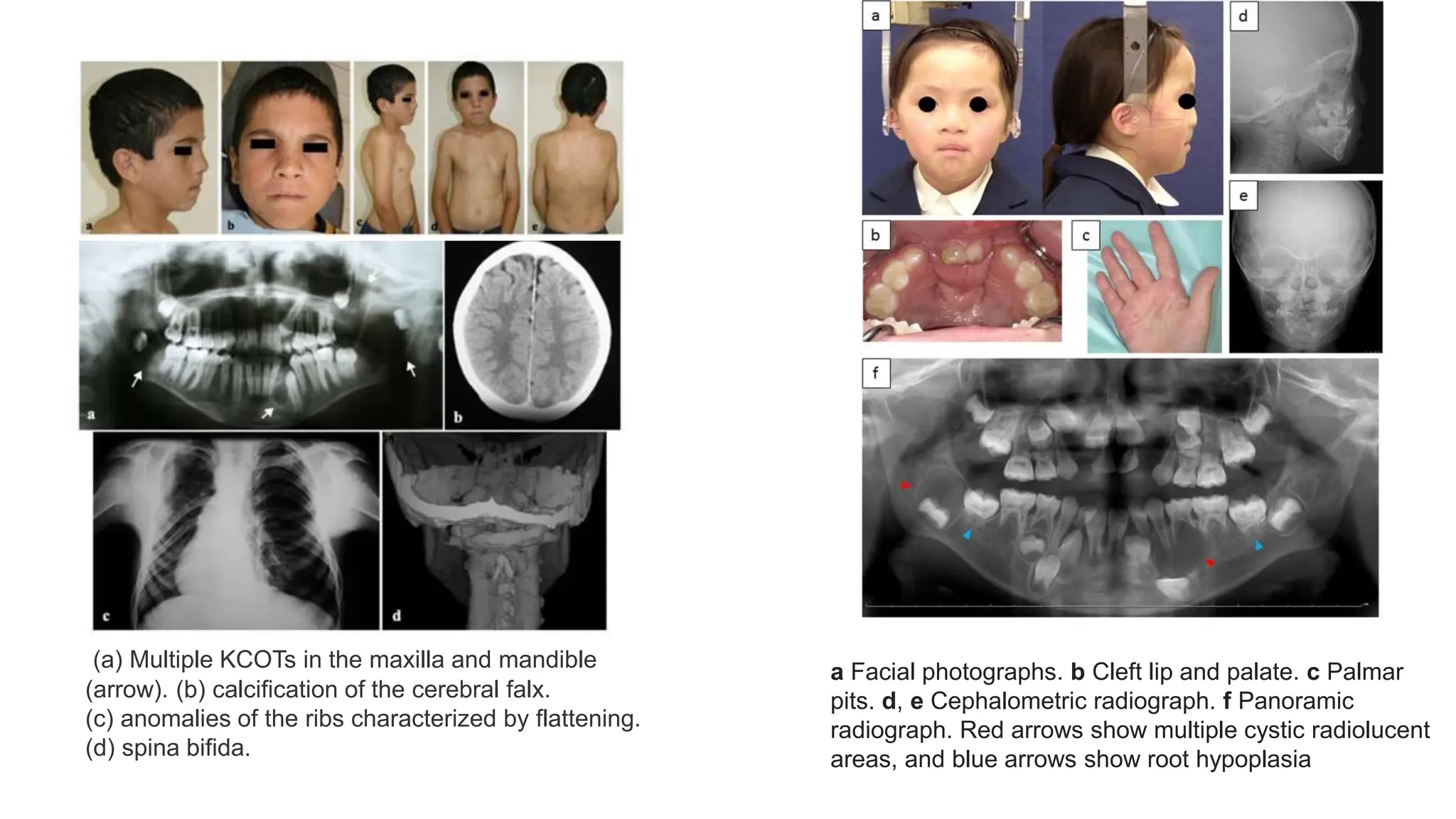 Classification and management Odontogenic cysts of oral cavity | PPTX