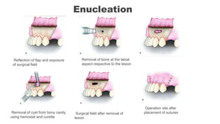 Classification and management Odontogenic cysts of oral cavity | PPTX ...