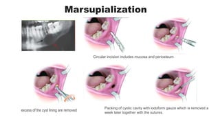Classification and management Odontogenic cysts of oral cavity | PPTX ...