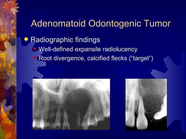 Odontogenic Tumors Radiographic findings | PPT