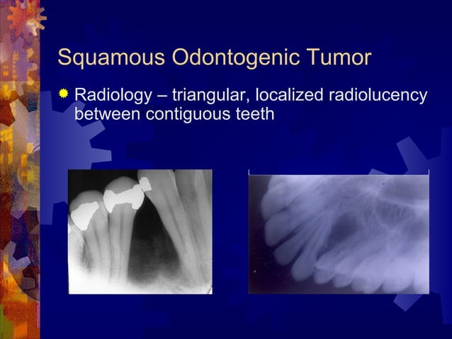 Odontogenic Tumors Radiographic findings | PPT