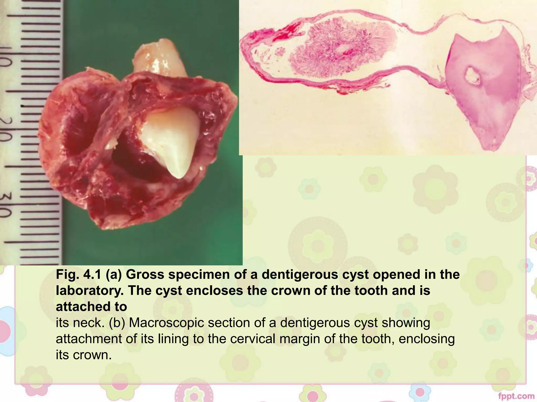 Odontogenic cyst | PDF