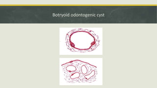 Odontogenic cyst | PPTX